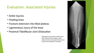 Tibial shaft fractures Managing soft tissues and infection | PPTX