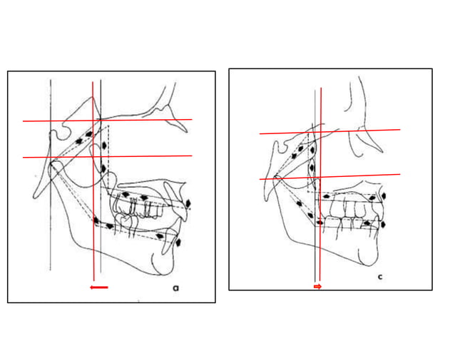 enlow counterpart principle with reference articles | PPTX | Bone and ...
