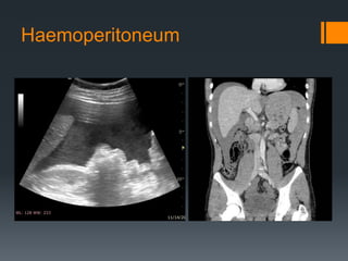7- Abdominal trauma 1 | PPT