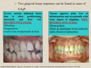 aggressive periodontitis | PPT | Dental Health | Diseases and Conditions