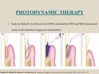 aggressive periodontitis | PPT