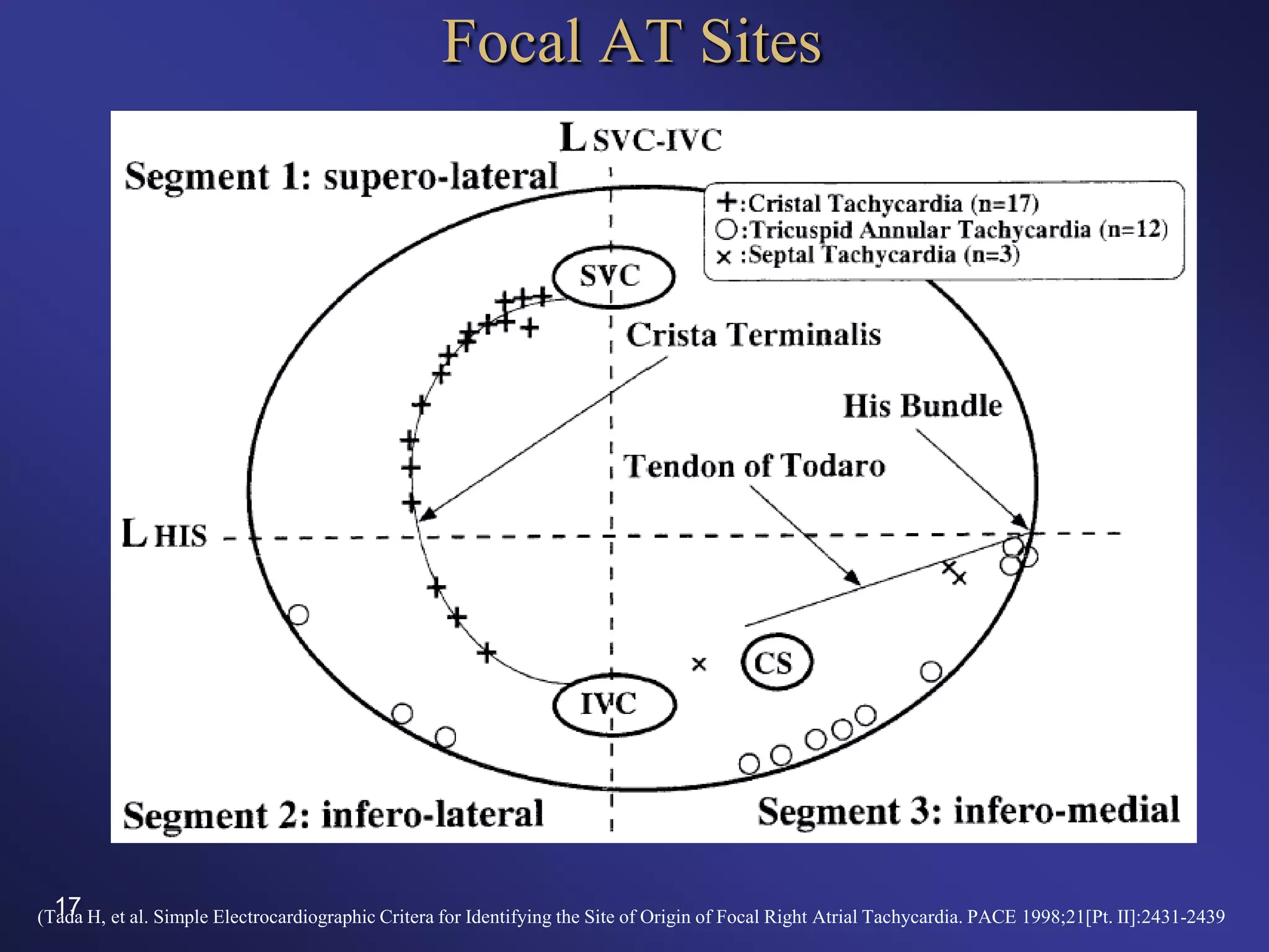 Atrial Tachycardia | PDF