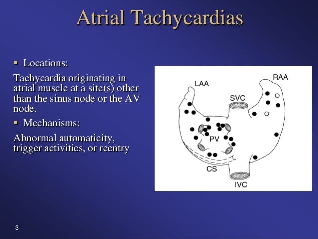 Atrial Tachycardia