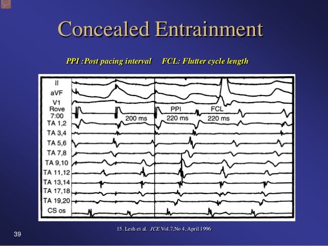 Atrial Tachycardia