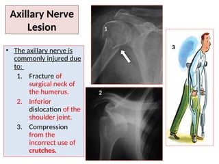 7- Axillary & Median Nehsbsvsgsgeegerves.ppt