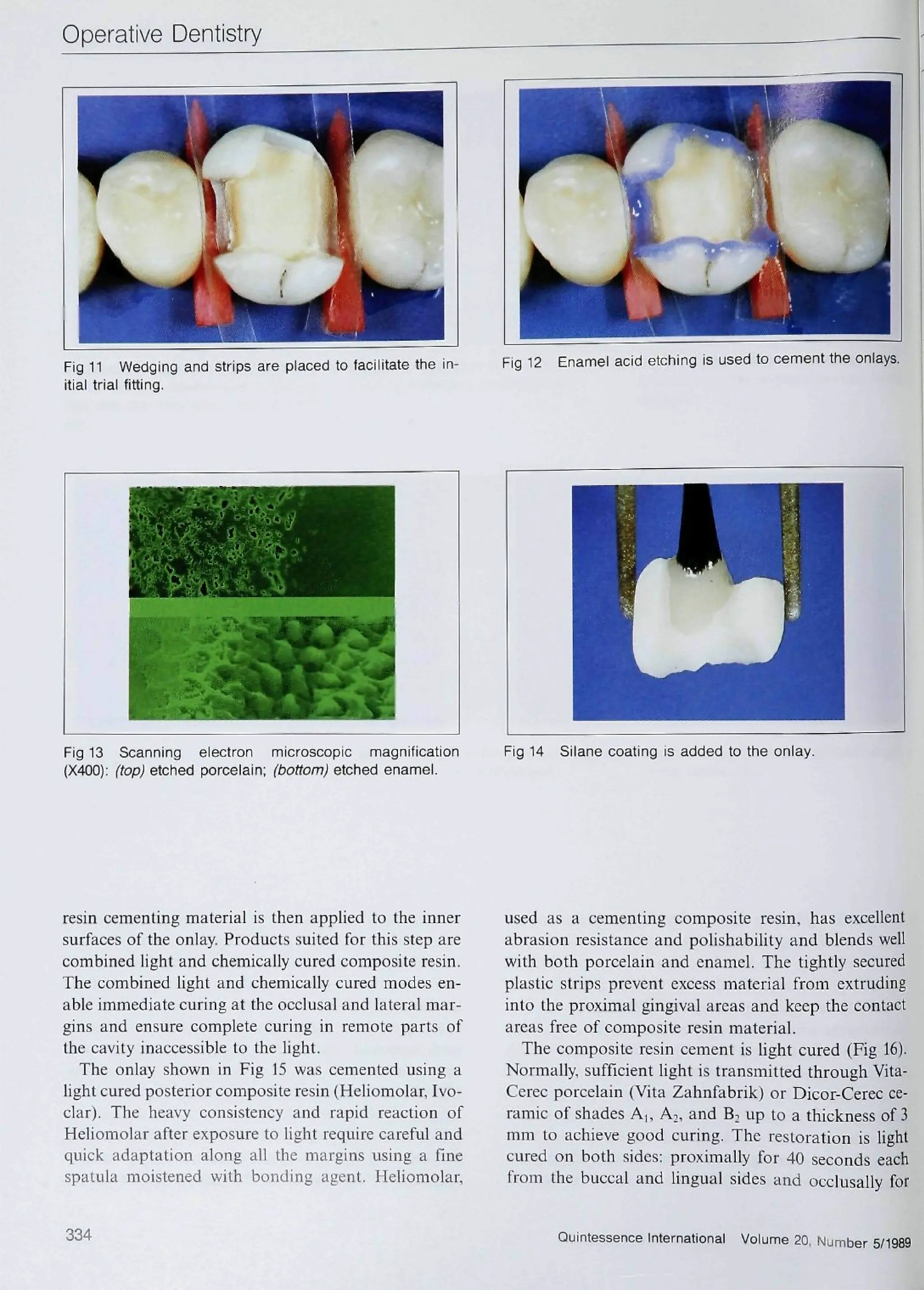 7 - Chairside computer-aided direct ceramic inlays.pdf