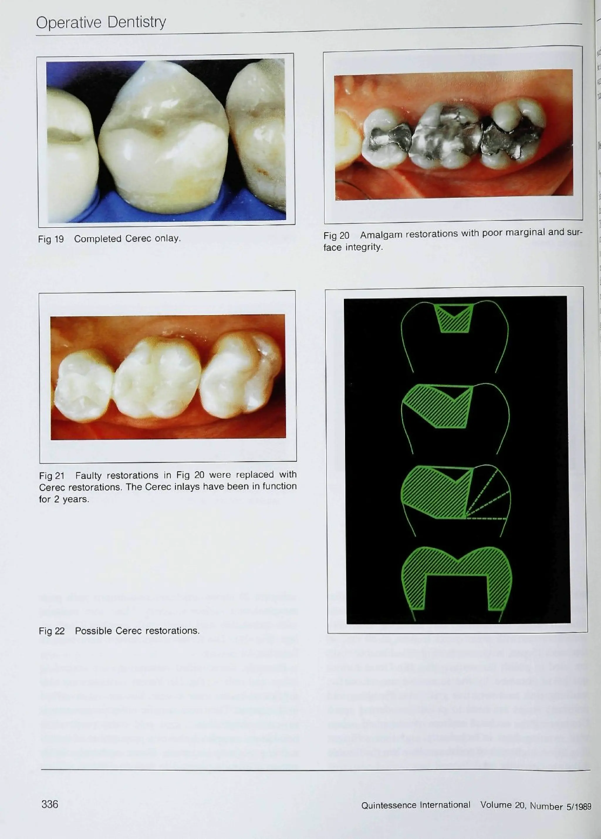 7 - Chairside computer-aided direct ceramic inlays.pdf
