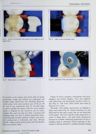7 - Chairside computer-aided direct ceramic inlays.pdf