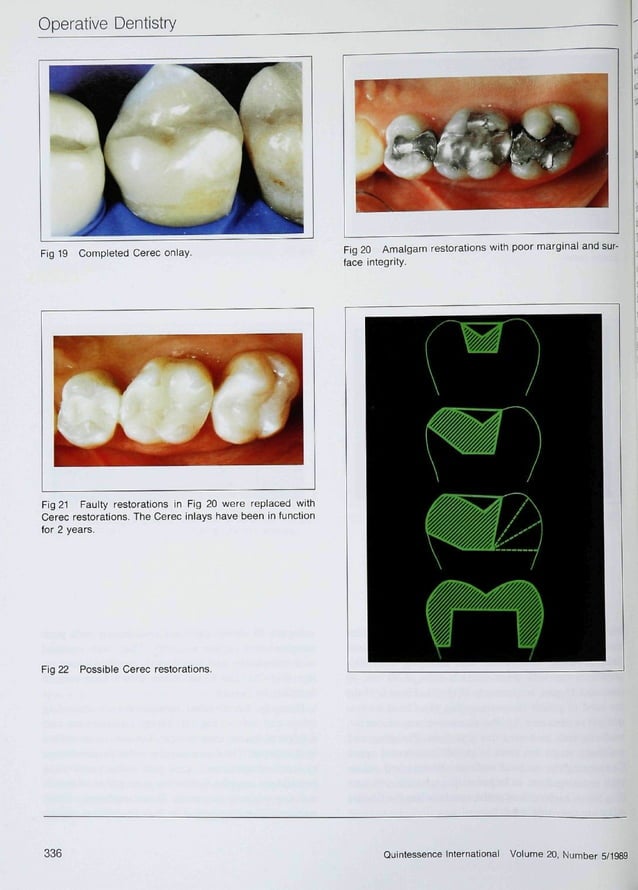7 - Chairside computer-aided direct ceramic inlays.pdf