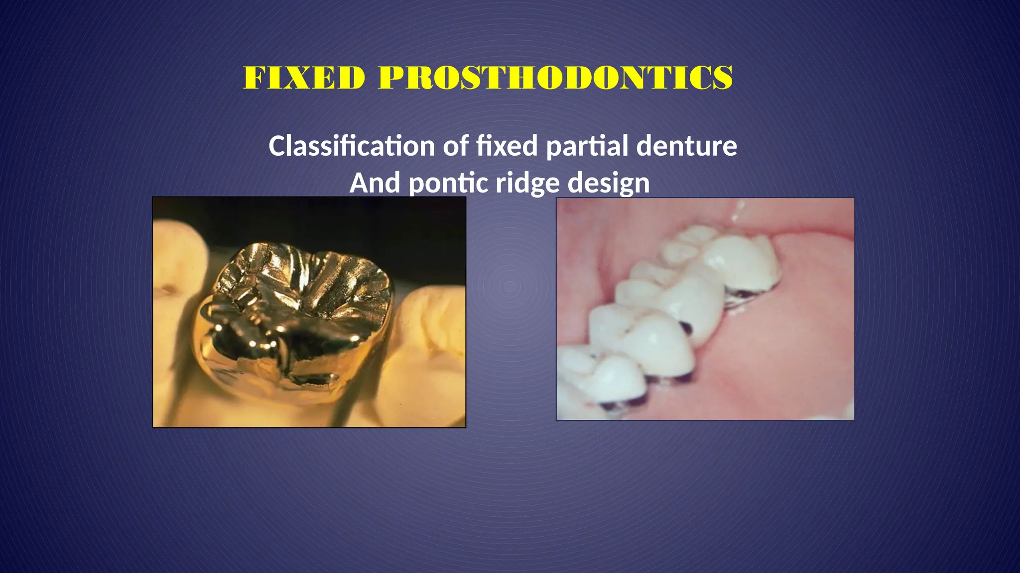 7- Classification of fixed partial denture.pptx