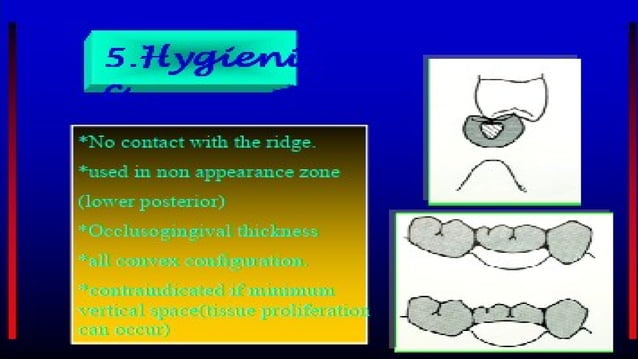7- Classification of fixed partial denture.pptx