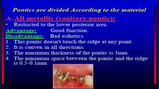 7- Classification of fixed partial denture.pptx