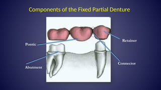 7- Classification of fixed partial denture.pptx