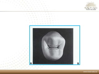 7- Class one amalgam cavity prep (1).pdf