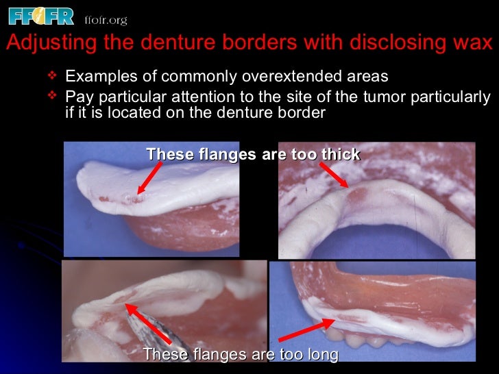 Complete Dentures for Irradiated Patients