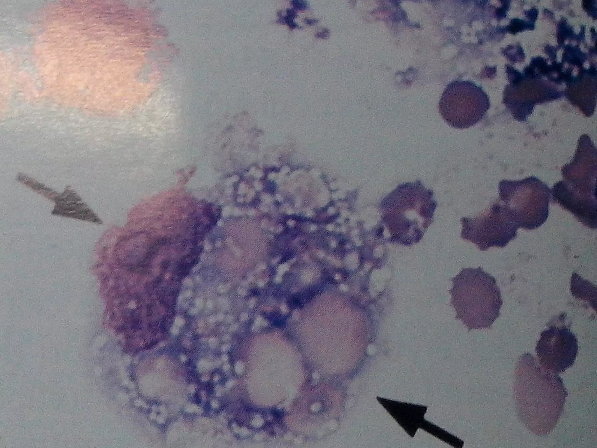 cytology of body fluid | PPT