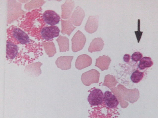 cytology of body fluid | PPT | Blood Disorders | Diseases and Conditions