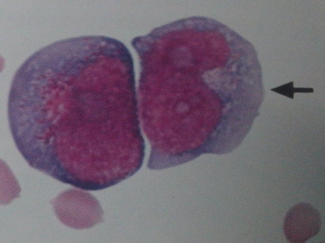 cytology of body fluid | PPT | Blood Disorders | Diseases and Conditions