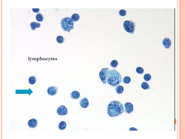cytology of body fluid | PPT | Blood Disorders | Diseases and Conditions