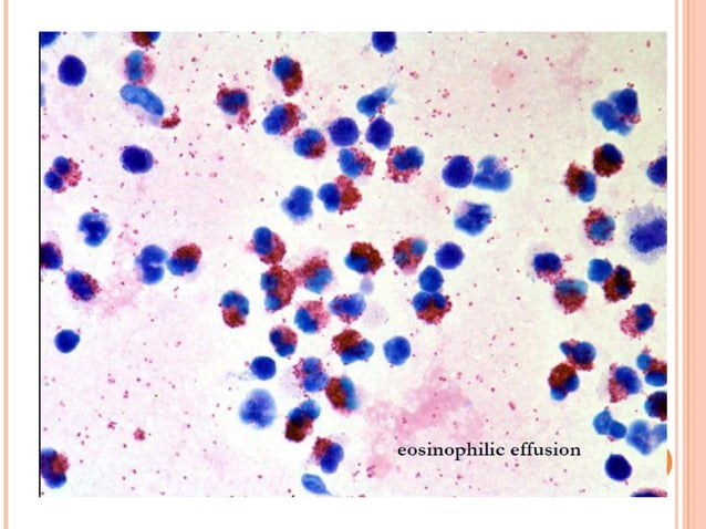 cytology of body fluid | PPT | Blood Disorders | Diseases and Conditions