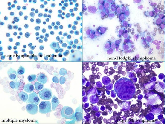 cytology of body fluid | PPT | Blood Disorders | Diseases and Conditions