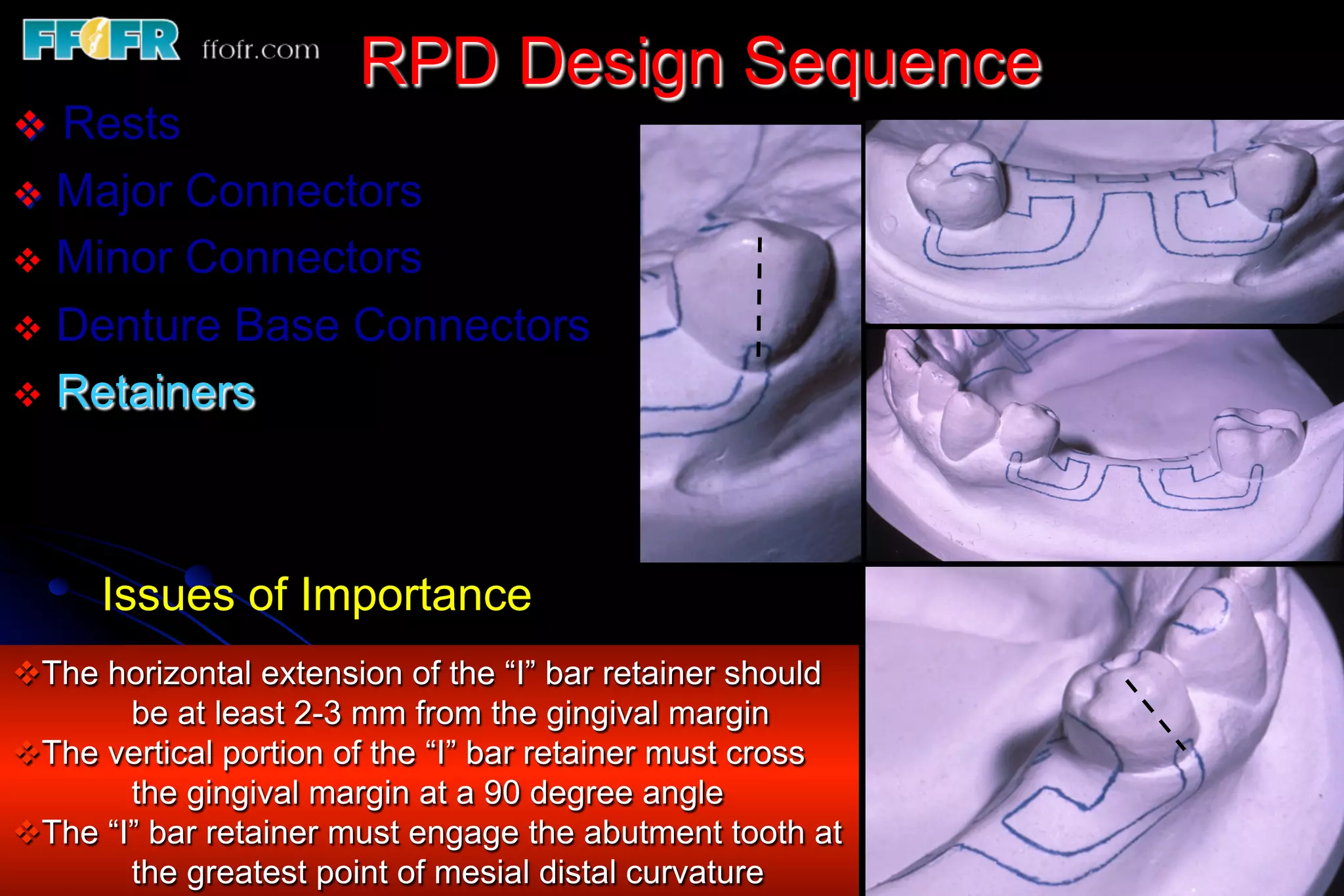7.designing rpd's, planning sequence for rpd patients | PDF