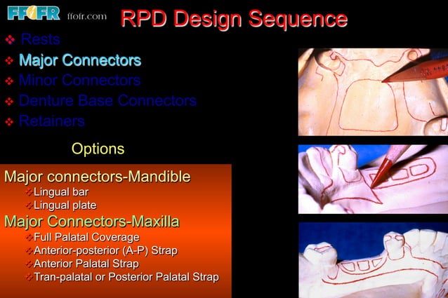 7.designing rpd's, planning sequence for rpd patients | PDF | Dental ...