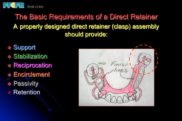 7.designing rpd's, planning sequence for rpd patients | PDF | Dental ...