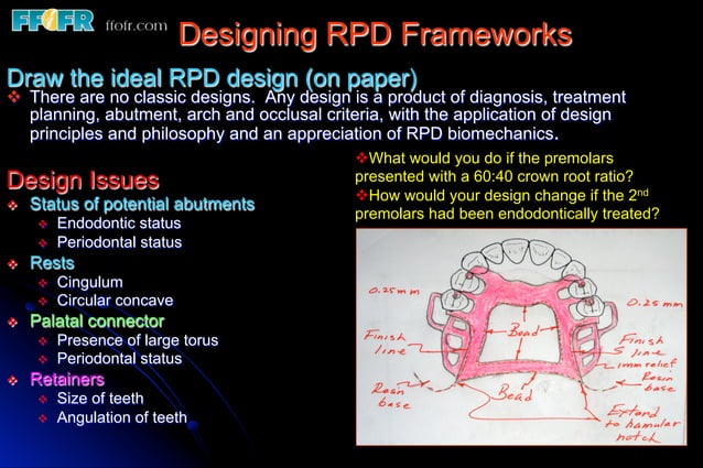 7.designing rpd's, planning sequence for rpd patients | PDF | Dental ...