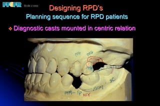 7.designing rpd's, planning sequence for rpd patients | PDF