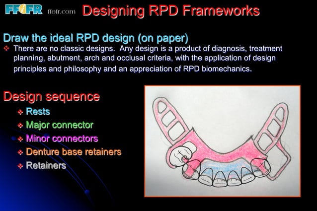 7.designing rpd's, planning sequence for rpd patients | PDF | Dental ...