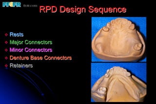 7.designing rpd's, planning sequence for rpd patients | PDF
