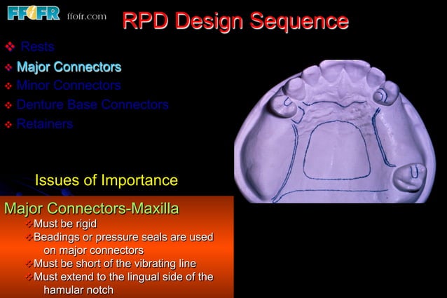 7.designing rpd's, planning sequence for rpd patients