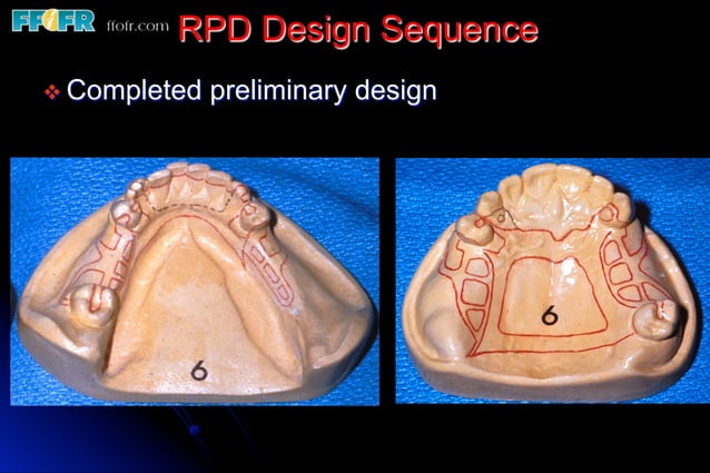 7.designing rpd's, planning sequence for rpd patients