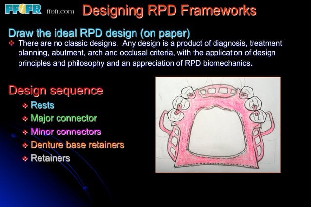 7.designing rpd's, planning sequence for rpd patients