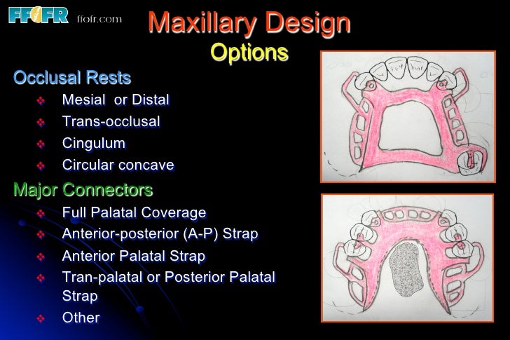 7.designing rpd's, planning sequence for rpd patients