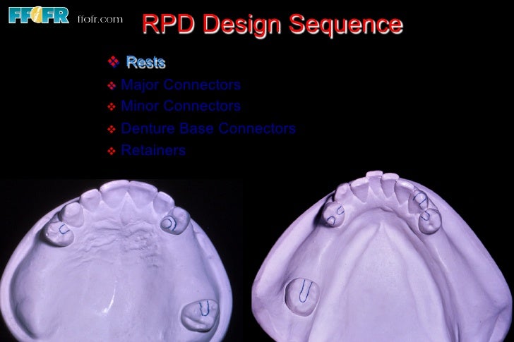 7.designing rpd's, planning sequence for rpd patients