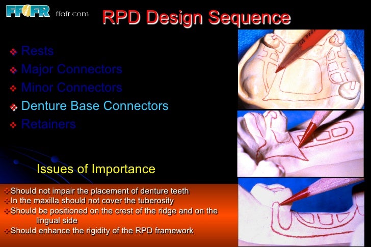 7.designing rpd's, planning sequence for rpd patients