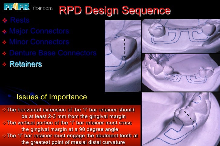 7.designing rpd's, planning sequence for rpd patients