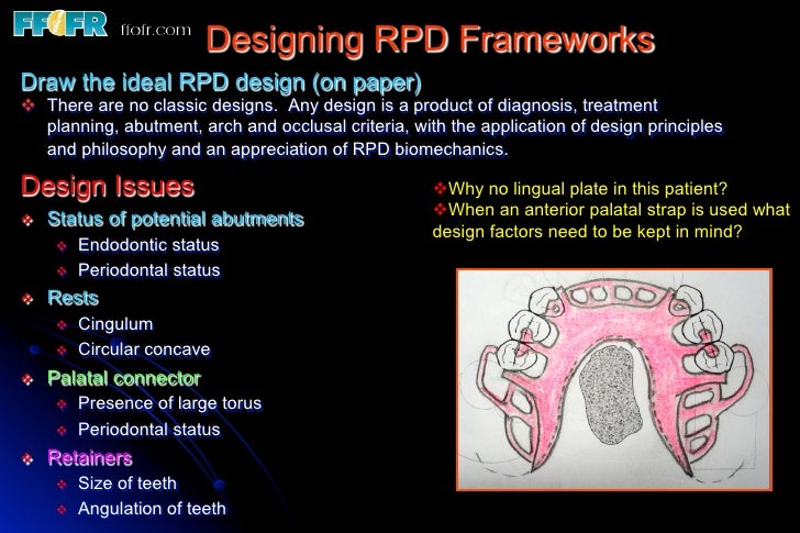 7.designing rpd's, planning sequence for rpd patients