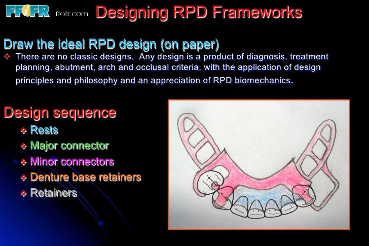 7.designing rpd's, planning sequence for rpd patients