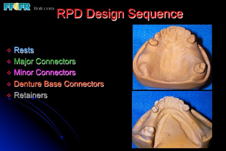 7.designing rpd's, planning sequence for rpd patients