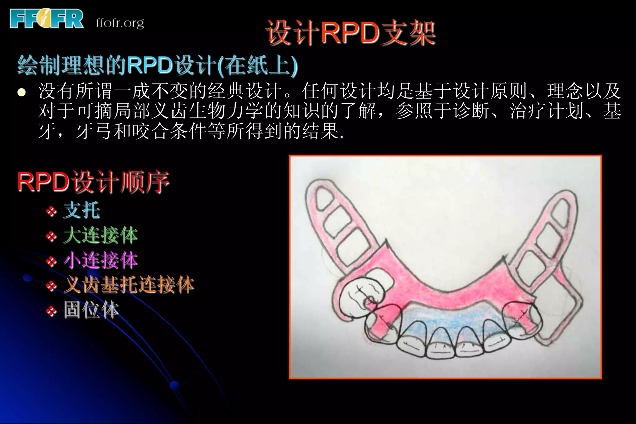 7.designing rpd's, planning sequence for rpd patients | PPT