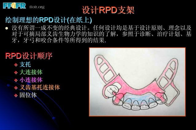 7.designing rpd's, planning sequence for rpd patients | PPT