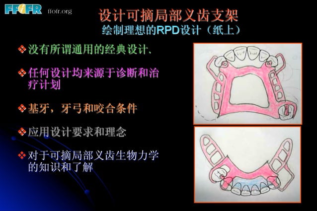 7.designing rpd's, planning sequence for rpd patients | PPT