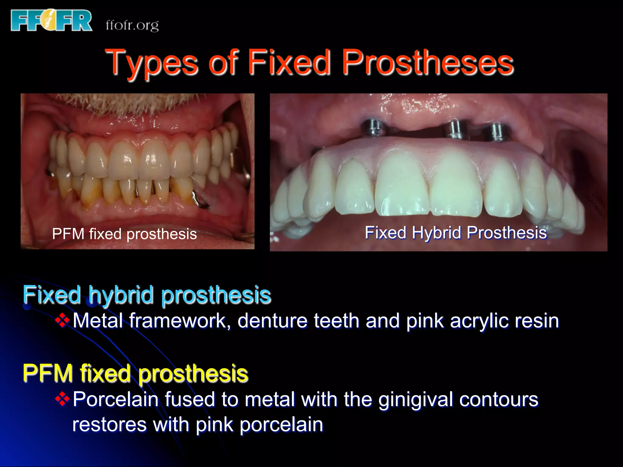 Edentulous Maxilla - Fixed Prostheses | PDF