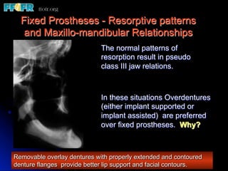 Edentulous Maxilla - Fixed Prostheses | PDF