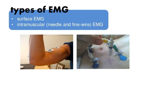 7 electromyoneuronography (emng)