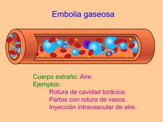 7. embolia e infarto | PDF