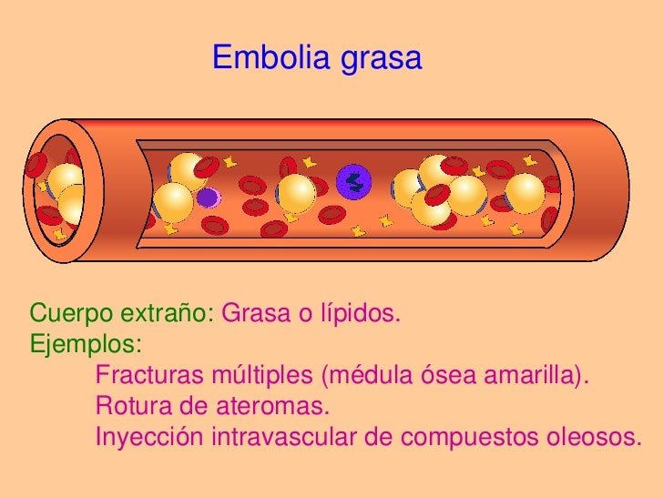 7. embolia e infarto